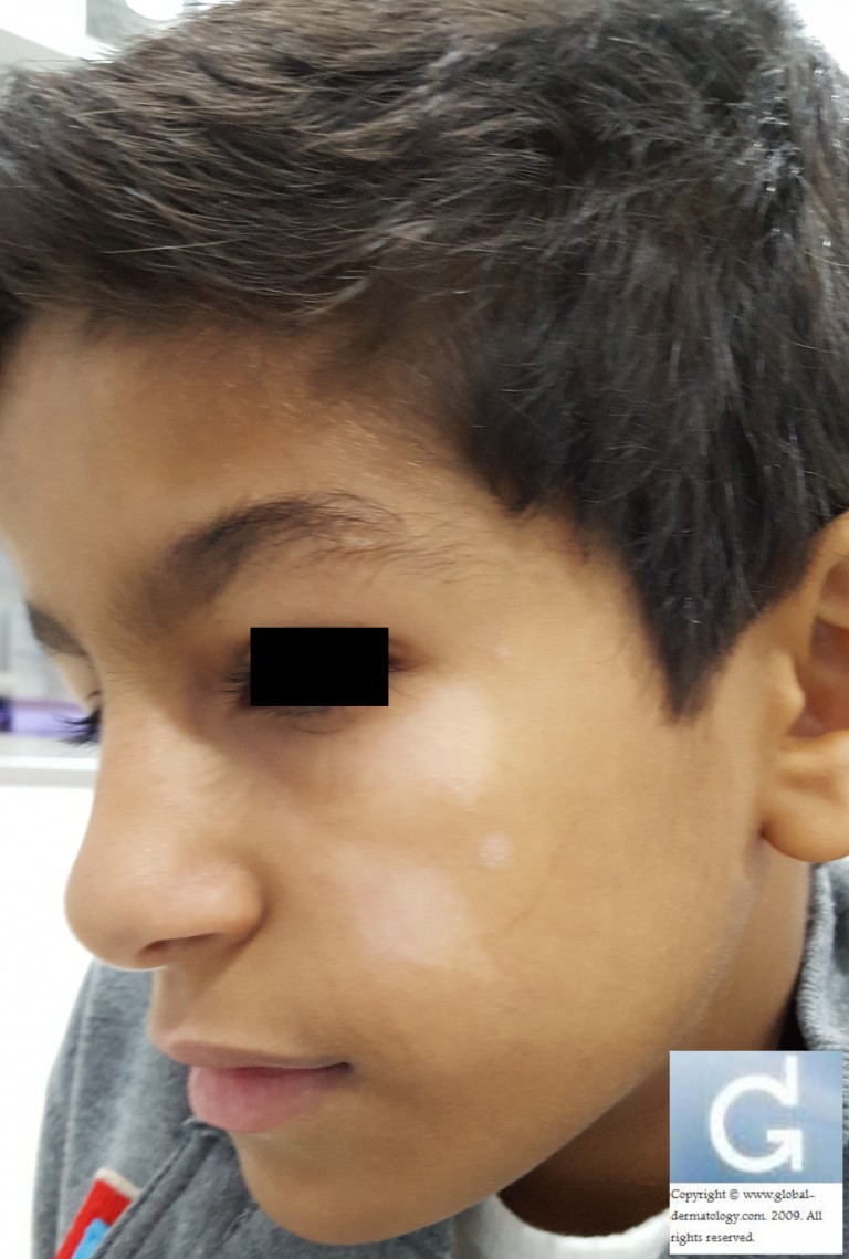 Global Dermatology » Pityriasis alba