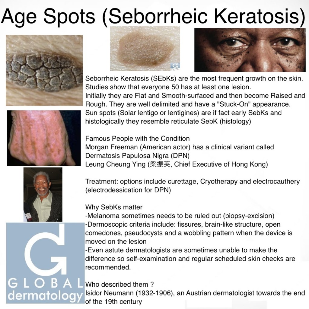 Global Dermatology » Age Spots (Instagram) (Seborrheic Keratosis ...